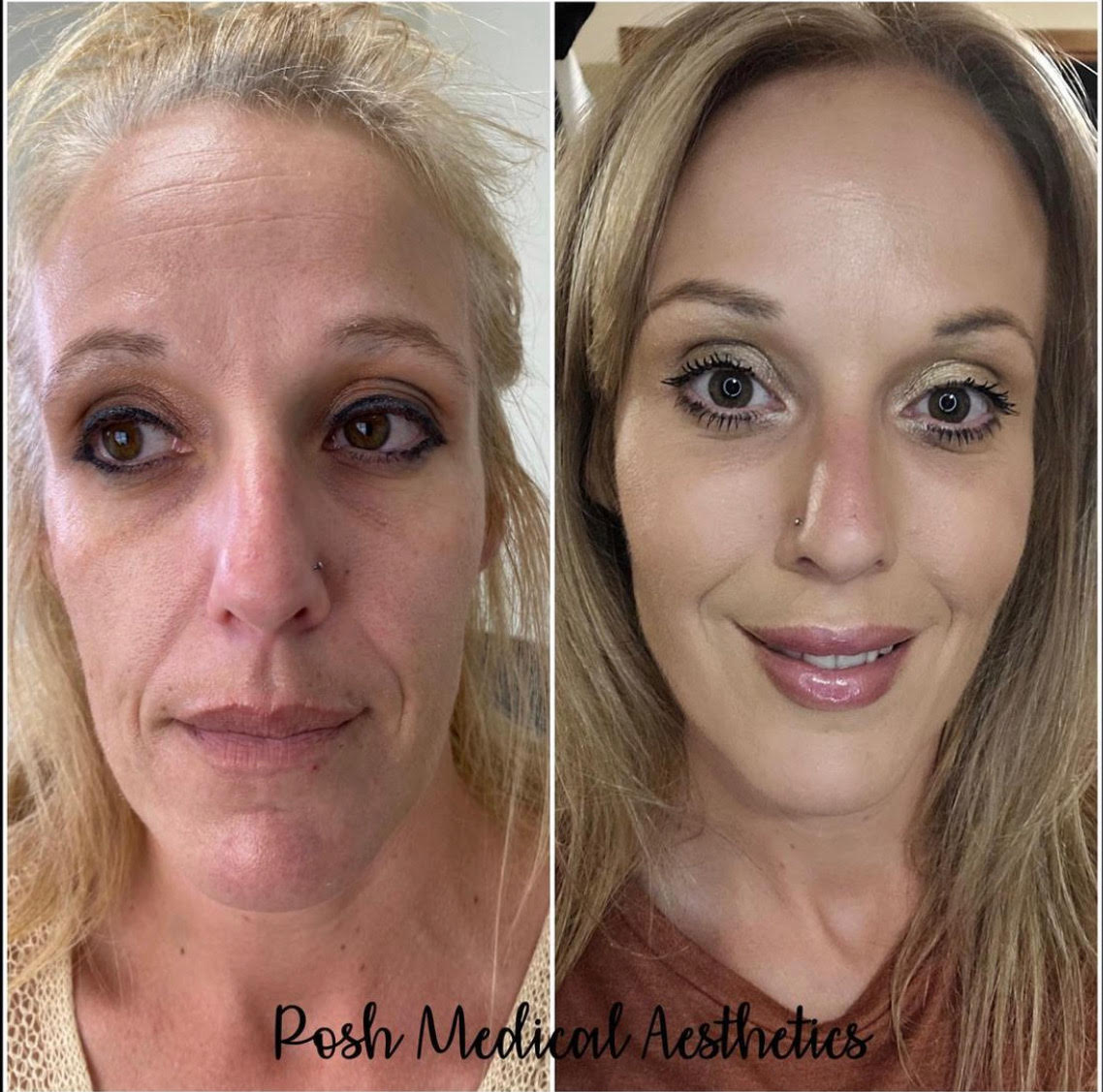 Before and After | Jessica Ellam Aesthetics