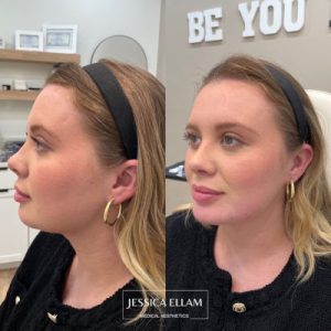 Before and After | Jessica Ellam Aesthetics